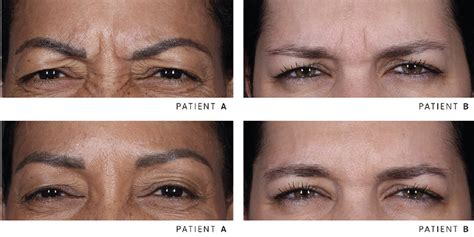 Smooth Wrinkles With DAXXIFY Injections In La Jolla CA Aurae MD