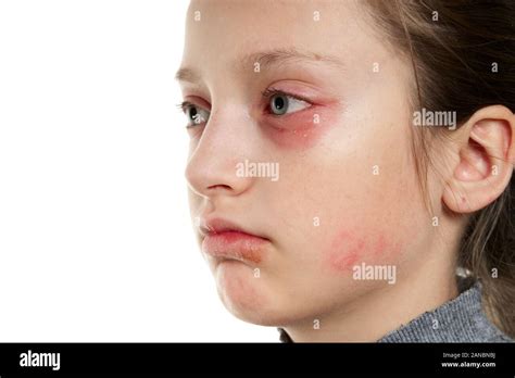 Allergic Reaction Skin Rash Close View Portrait Of A Girls Face Redness And Inflammation Of