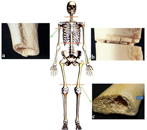 Case 1 — A Severed Proximal Epiphysis Of The Right Humerus