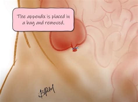 Open Appendectomy Incision