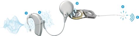 How Do Cochlear Implants Work Advanced Bionics