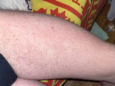 Is This Post Scabies Or Active Rscabies