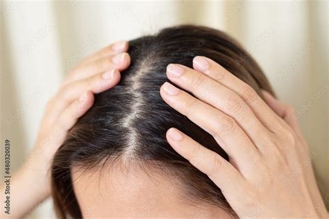Dandruff Scalp Fungus