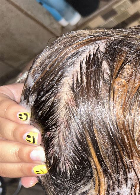 Dandruff Dry Scalp Psoriasis R Dandruff