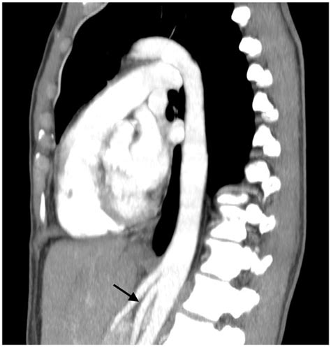 Nutcracker Syndrome As An Uncommon Cause Of Isolated Hematuria In Adults