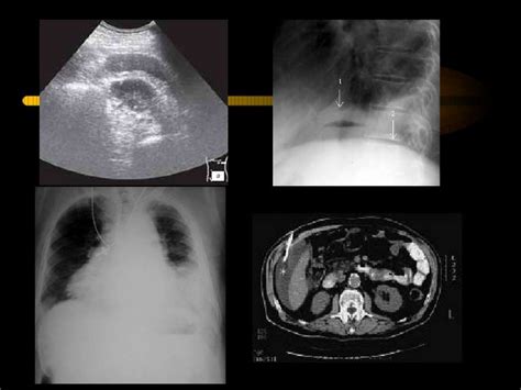 Acute Peritonitis Online Presentation