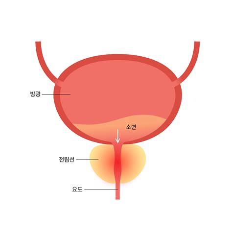 전립선비대증 치료 유로리프트의 효과는 네이버 블로그