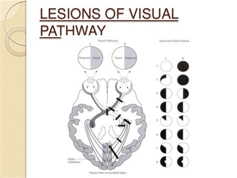 Anatomy Of Visual Pathway Field Defects And Its Lesions