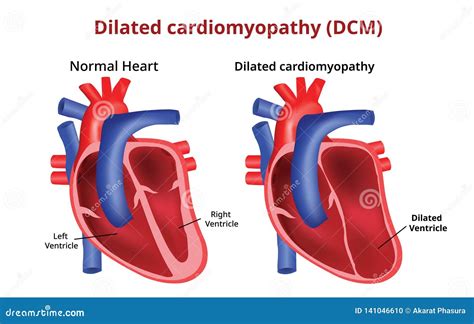Cardiomyopathy Cartoons Illustrations And Vector Stock Images 608