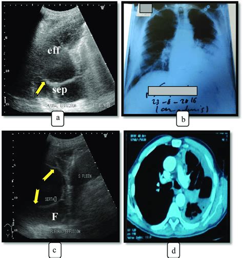 Icu Patient Chest Us Shows Lt Multiloculated Pleural Effusion With Download Scientific