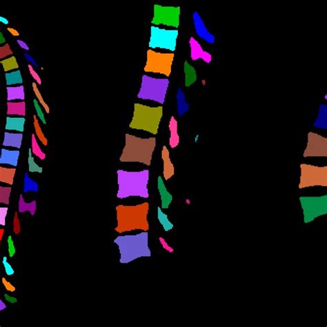 Pdf Segmentation And Identification Of Vertebrae In Ct Scans Using