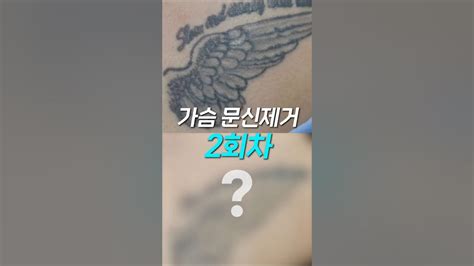 가슴 문신제거 2회차얼마나 지워질까수면마취 No Youtube