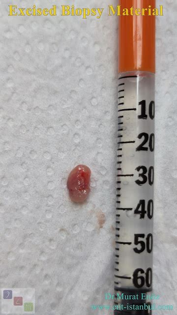 A Simple Partial Uvulectomy Technique Under Local Anesthesia For The