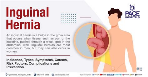 Inguinal Hernia Signs And Symptoms Types Causes Risk 60 Off