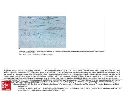 Amplitude Versus Frequency Transvaginal Color Doppler Sonography TV CDS A Frequency Based TV