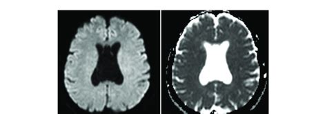 No Restriction Of Diffusion Is Noted In Diffusion Weighted Images A Download Scientific