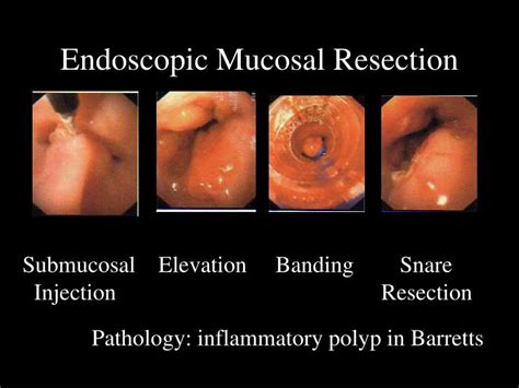 Ppt Endoscopic Mucosal Resection Powerpoint Presentation Id303427