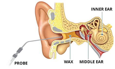Ear Wax
