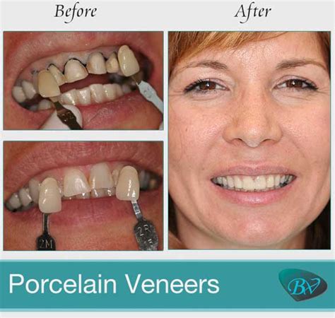 Porcelain Veneers Procedure Video At Wendell Espinoza Blog