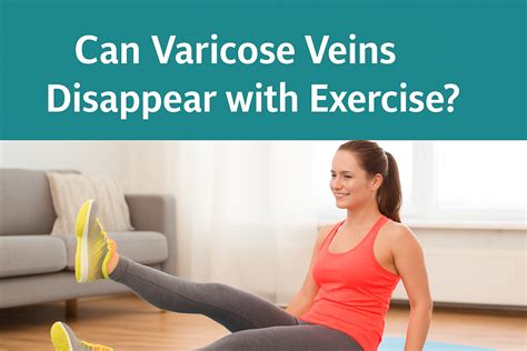 5 Effective Treatments For Varicose Veins Recommended By Specialists