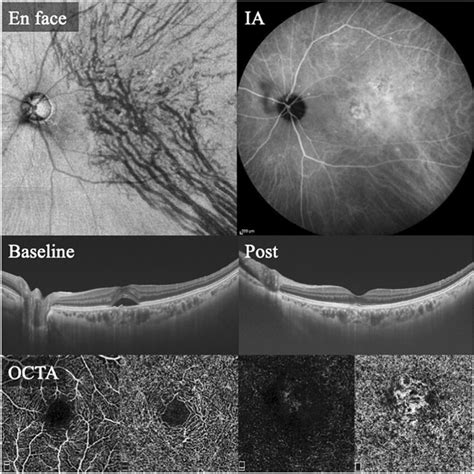Findings In A 70 Year Old Woman A Representative Case Of A Type 1 Mnv Download Scientific