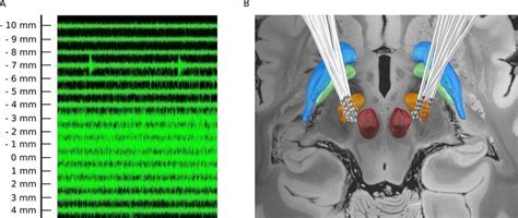 A Raw Microelectrode Recordings Mer Obtained From Different Depth