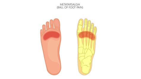 Metatarsalgia Ball Of Foot Pain Symptoms And Causes Entirely Health