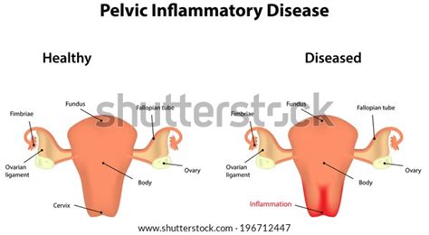 Pelvic Inflammatory Disease Stock Vector Royalty Free 196712447