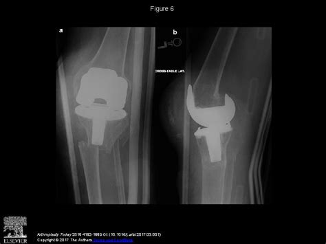 Circular Hexapod External Fixation For Periprosthetic Tibial Fracture