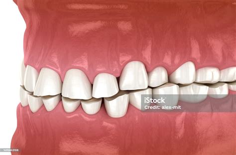 치아 감소 는 치아 조직의 손실을 초래합니다 치과용 3d 일러스트레이션 0명에 대한 스톡 사진 및 기타 이미지 0명 감각 지각 건강관리와 의술 Istock