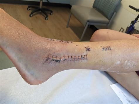 Fractured Distal Tibia And Fibula 3 Wks Post Op My Experience Long Post In Comments Hope
