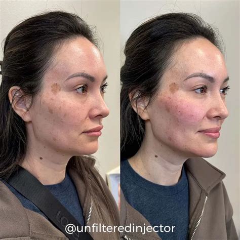 Cheek Filler Before And After Real Results And Insights Hubmed