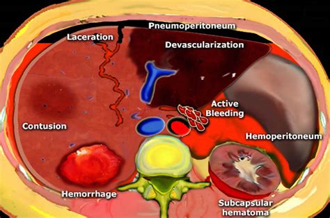 Hemoperitoneum Causes Signs Symptoms Diagnosis Treatment And Prognosis