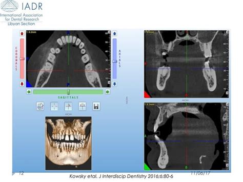 Use Of Cone Beam Computed Tomography In Endodontics Ppt