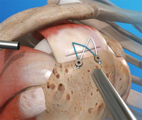 Rotator Cuff Repair Surgery In Dahisar Dr Anand Walavalkar