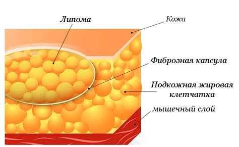 Удаление липомы