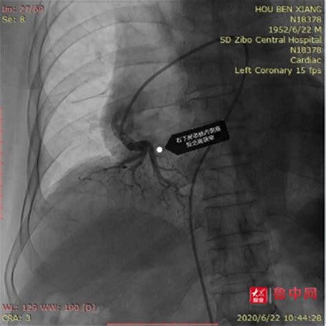 气囊扩张术 皮肤扩术 封堵气囊 大山谷图库