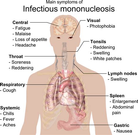 Download Main Symptoms Of Infectious Mononucleosis Epstein Barr Virus
