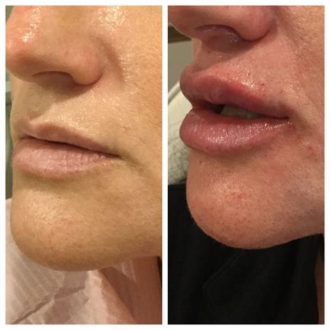 Chin Botox Dramatic Before And After Transformations Cost Results And More Chaztin