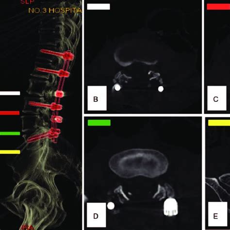 Pdf Catastrophic Thoracolumbar Spinal Massive Hematoma Triggered By