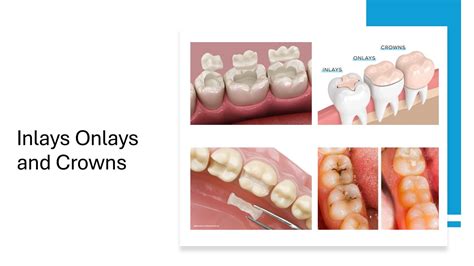 Crown Inlay Inlay Onlay Für Zähne In Zagreb Kroatien Bdent