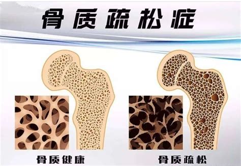 骨质疏松你真的了解吗3分钟带你认识它的真面目