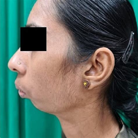 Right Profile Showing A Convex Profile Of The Patient Download Scientific Diagram