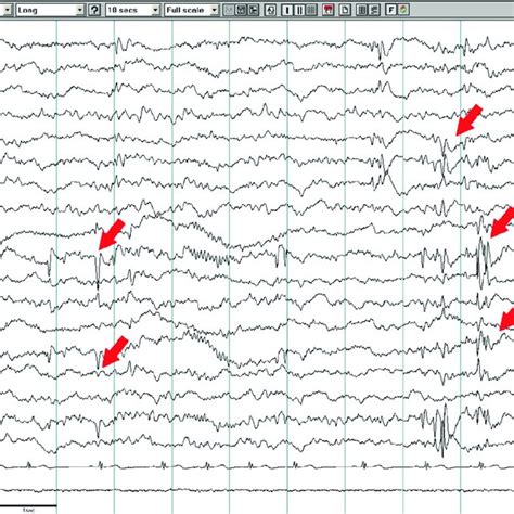 Epileptiform Discharges Wake Eeg And Overnight Sleep Eeg Psg N 55 Download Scientific