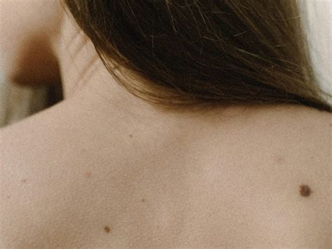 Mole Mapping Can Help Prevent Skin Cancer I Tried It