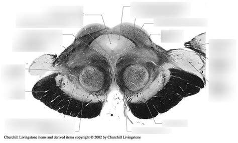 Mesencephalic Diencephalic Junction Diagram Quizlet