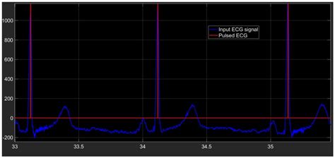 Fpga Based Decision Support System For Ecg Analysis
