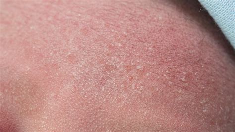 Itchy Rash On Forehead Drbrowns