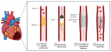 Rotational Atherectomy Orbital Atherectomy And Intravascular Lithotripsy Comparison For