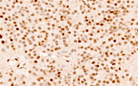 Pathology Outlines Pituitary Neuroendocrine Tumor Pitnet